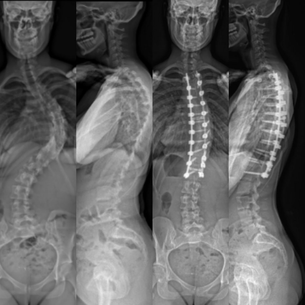 Scoliosis Surgery | South Australian Scoliosis Service